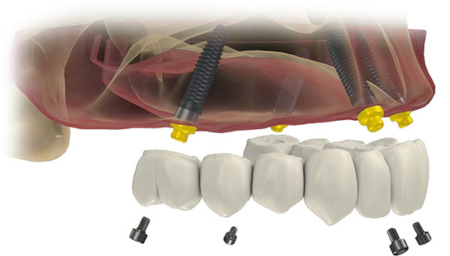Fixed Prosthesis OT Bridge | Rhein83