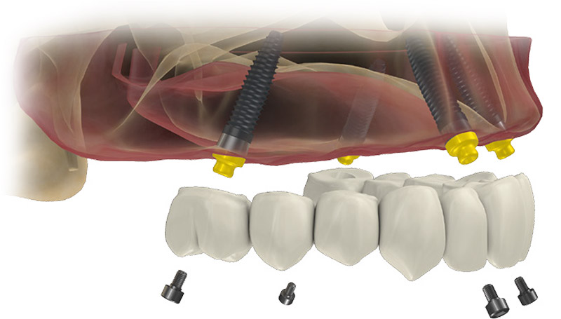 OT-BRIDGE-PROTESI | RHEIN83