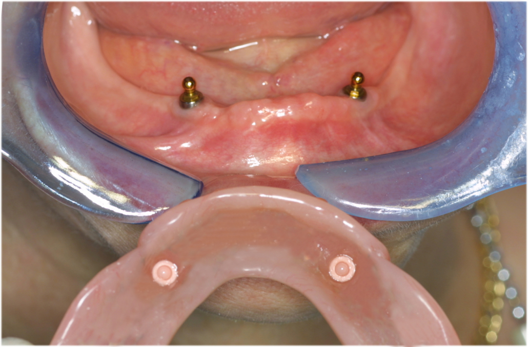 Sphero Block attacco diretto per impianti ‣ RHEIN83