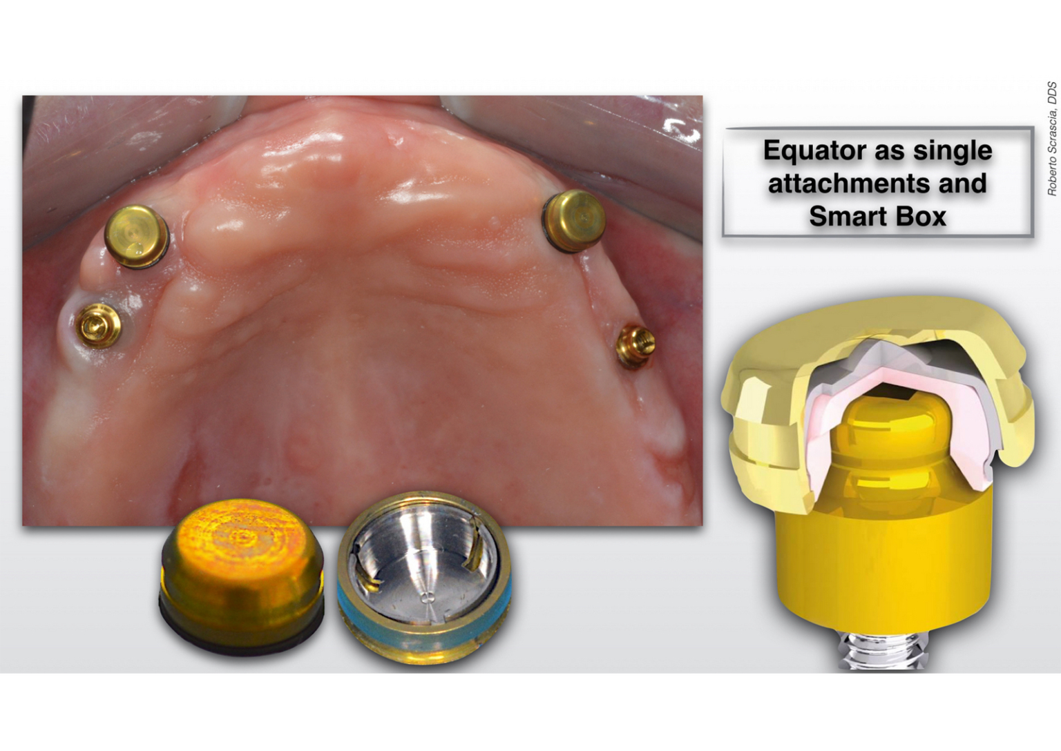 OT EQUATOR ATTACHMENT: FOR ALL IMPLANT PLATFORMS | Rhein83
