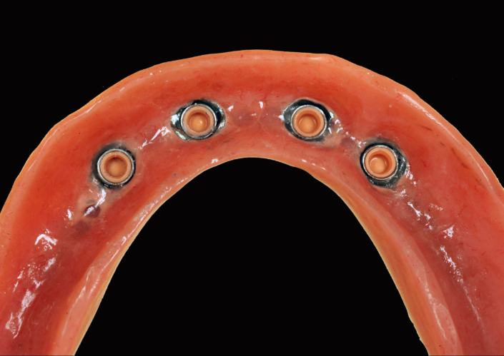 OT EQUATOR ATTACHMENT: FOR ALL IMPLANT PLATFORMS | Rhein83