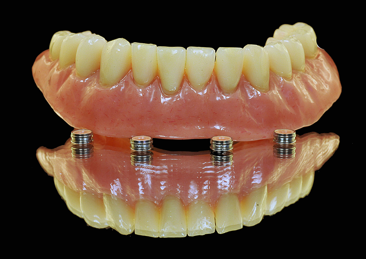 Implant retained overdenture restorations | Rhein83