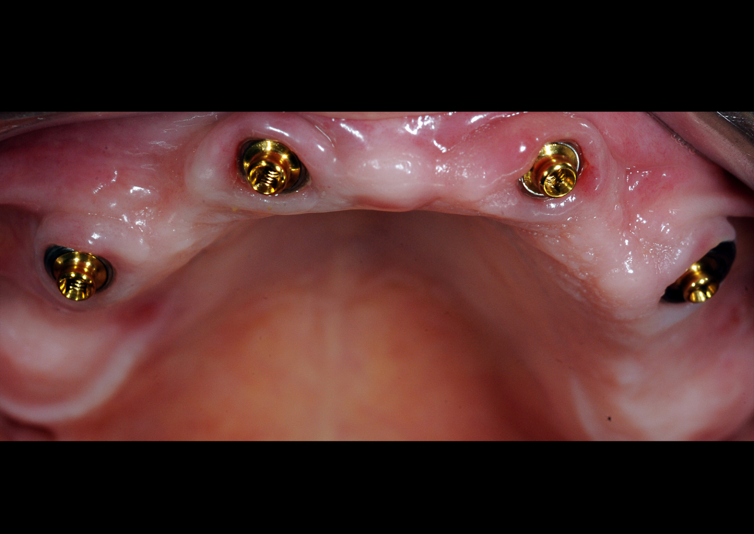 OT EQUATOR ATTACHMENT: FOR ALL IMPLANT PLATFORMS | Rhein83