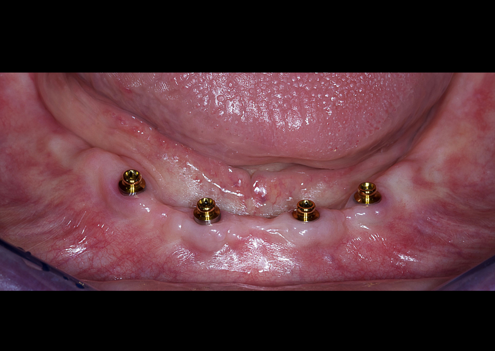 OT EQUATOR ATTACHMENT: FOR ALL IMPLANT PLATFORMS | Rhein83