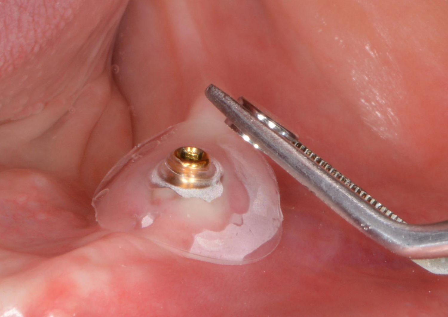 Implant retained overdenture restorations | Rhein83