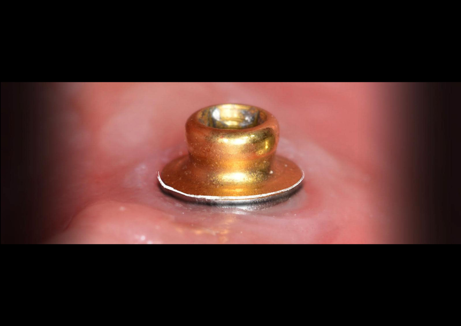 OT EQUATOR ATTACHMENT: FOR ALL IMPLANT PLATFORMS | Rhein83