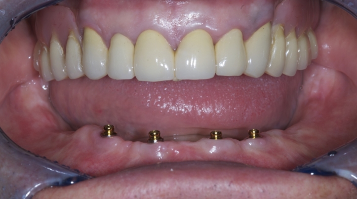 OT EQUATOR ATTACHMENT: FOR ALL IMPLANT PLATFORMS | Rhein83