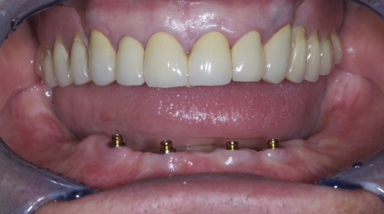 OT EQUATOR ATTACHMENT: FOR ALL IMPLANT PLATFORMS | Rhein83