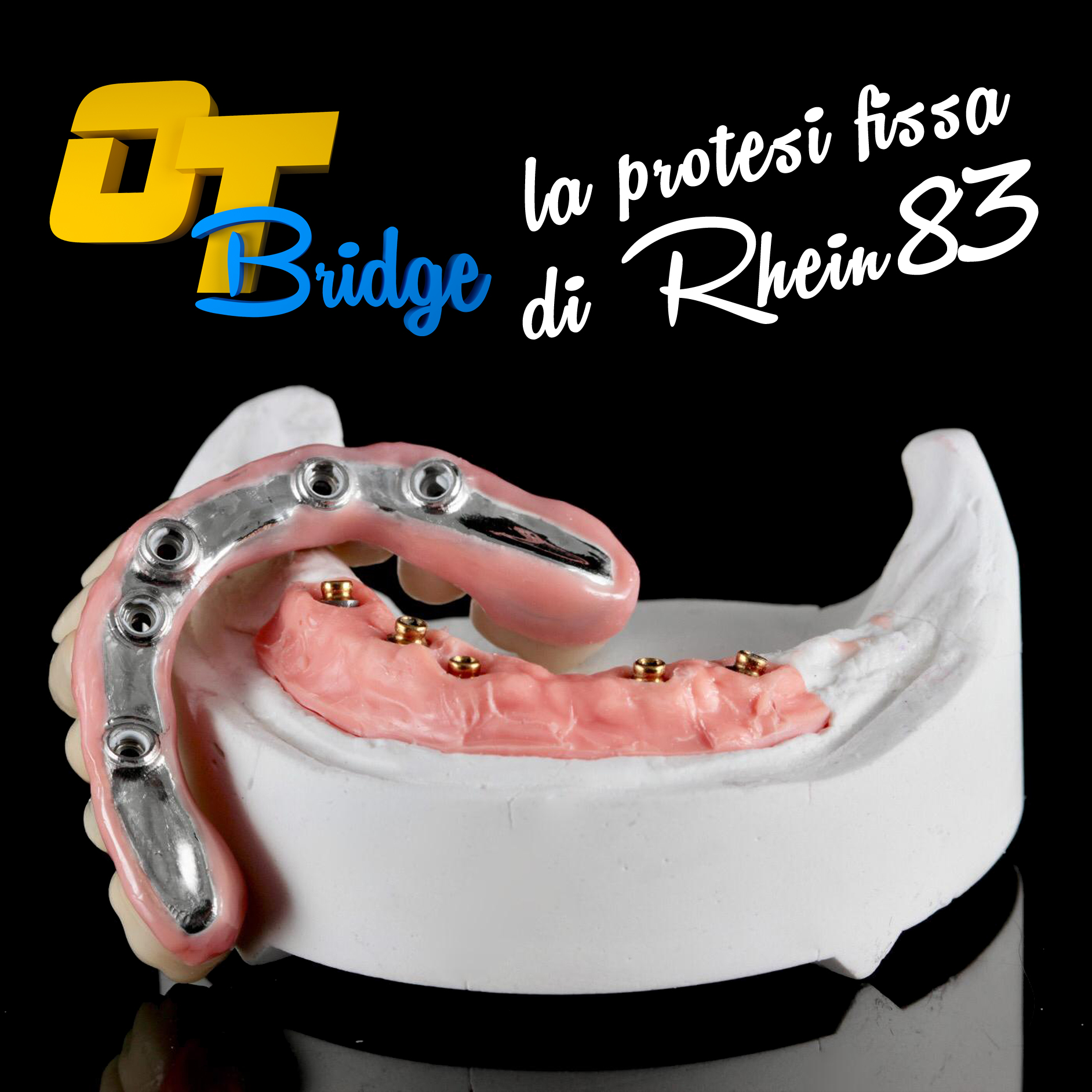 OT BRIDGE – La protesi fissa di Rhein83 | Rhein83