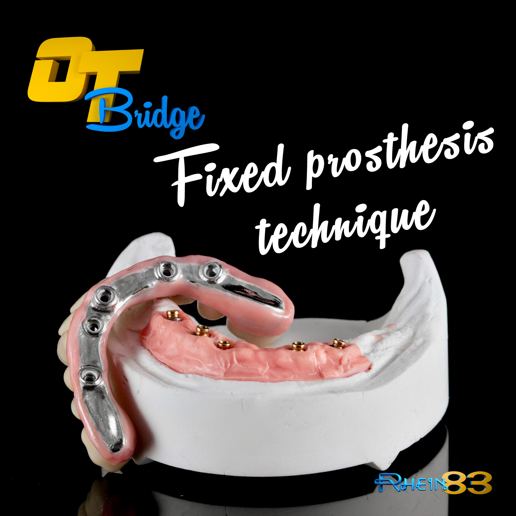 RHEIN83| OT BRIDGE TECHNIQUE: FIXED PROSTHESIS RESTORATIONS