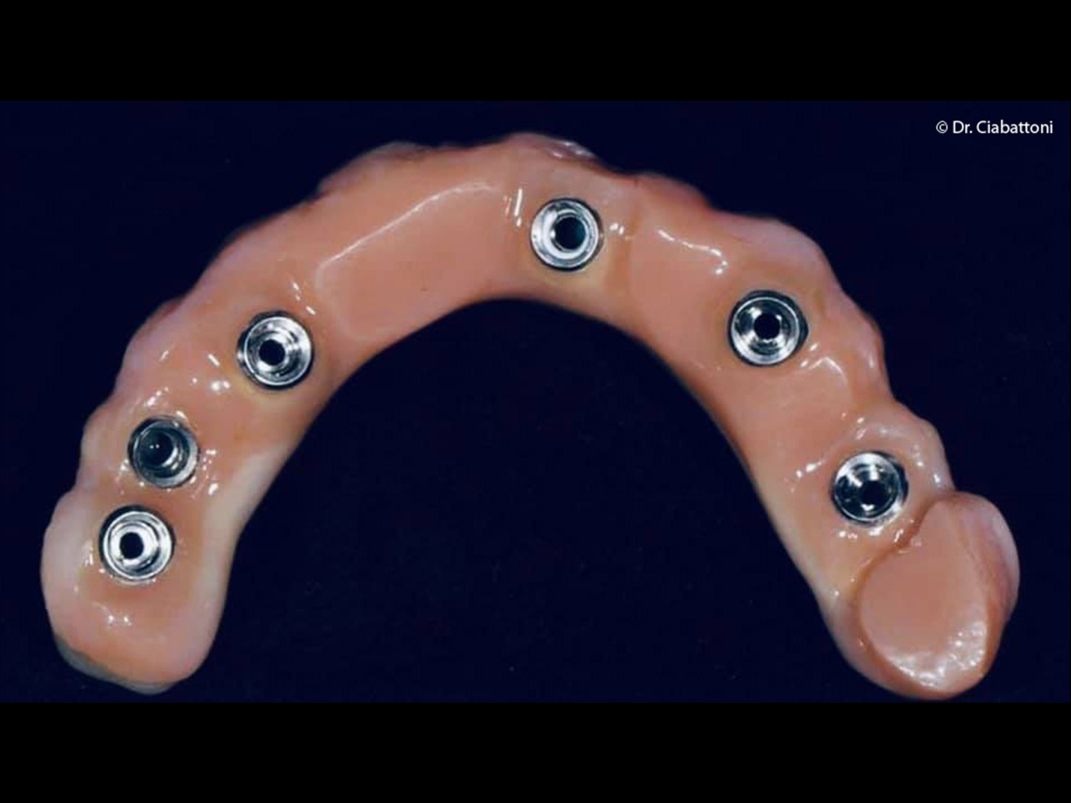 OT BRIDGE – LA PRÓTESIS FIJA DE RHEIN83 | Rhein83