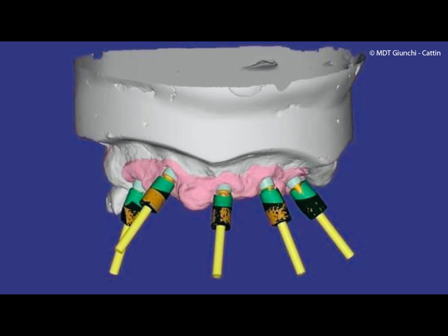 Rhein83| OT BRIDGE TECHNIQUE: FIXED PROSTHESIS RESTORATIONS