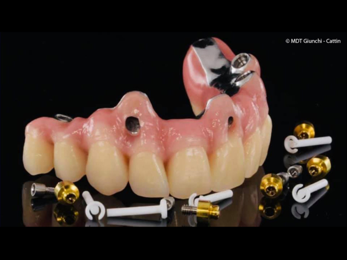 OT BRIDGE – LA PRÓTESIS FIJA DE RHEIN83 | Rhein83