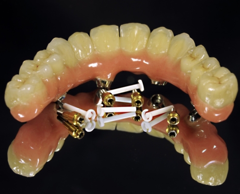 Rhein83| OT BRIDGE TECHNIQUE: FIXED PROSTHESIS RESTORATIONS