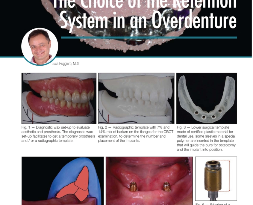 Implant retained overdenture with Ball Attachments | Rhein83