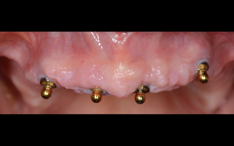 Implant retained overdenture with Ball Attachments | Rhein83