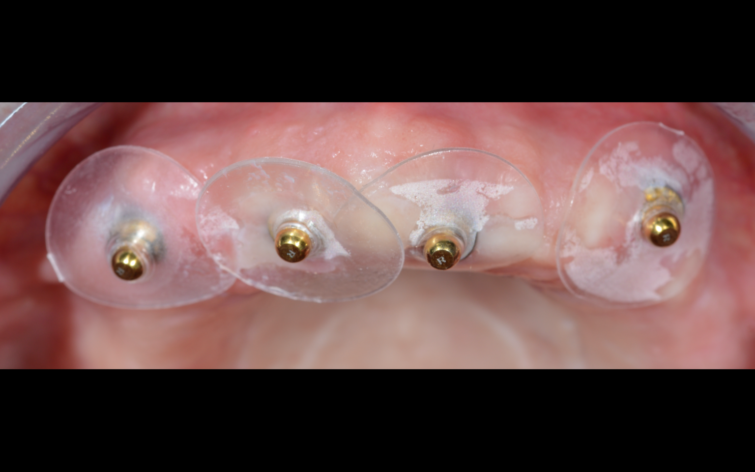 Implant retained overdenture with Ball Attachments | Rhein83
