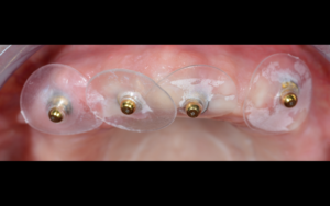 Implant retained overdenture with Ball Attachments | Rhein83
