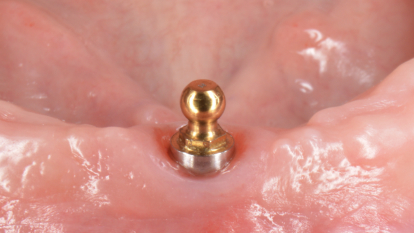 Implant retained overdenture with Ball Attachments | Rhein83