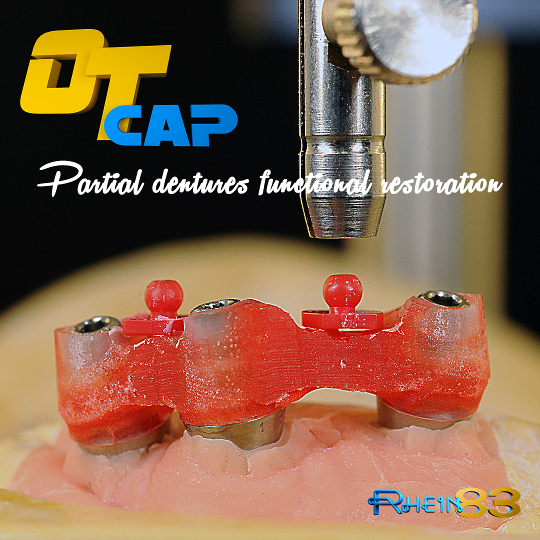 OT CAP ATTACHMENTS: PARTIAL DENTURES FUNCTIONAL RESTORATIONS | RHEIN83