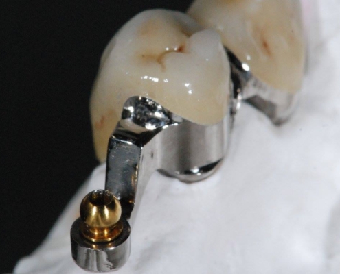 OT CAP ATTACHMENTS: PARTIAL DENTURES FUNCTIONAL RESTORATIONS | Rhein83