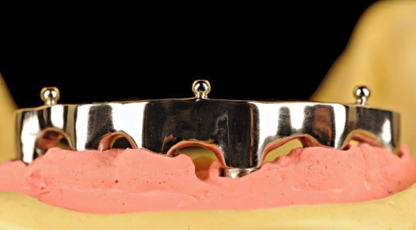 OT CAP ATTACHMENTS: PARTIAL DENTURES FUNCTIONAL RESTORATIONS | Rhein83