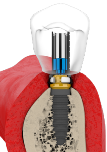 OT EQUATOR PROSTHETICS RESTORATIONS | Rhein83