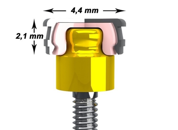 Implant retained overdenture restorations | Rhein83