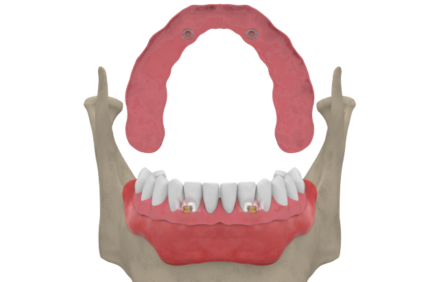 Implant retained overdenture restorations | RHEIN83
