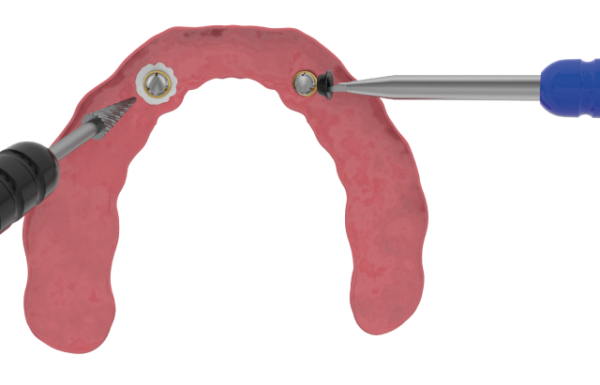 Implant retained overdenture restorations | RHEIN83