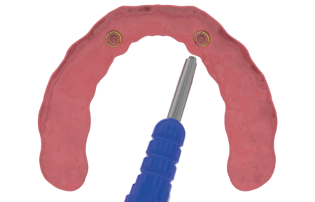 Implant retained overdenture restorations | RHEIN83